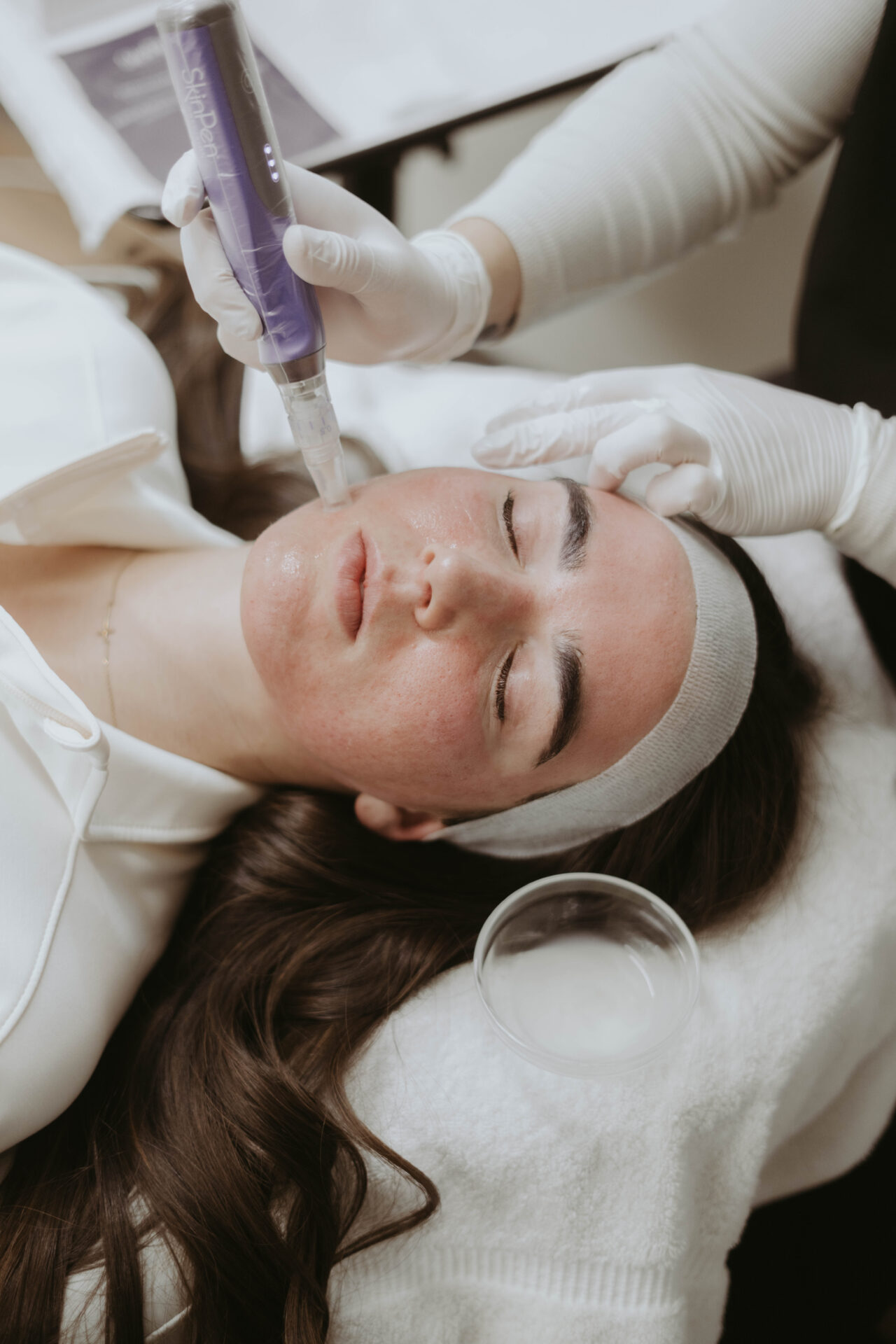SkinPen Microneedling Duluth MN | Synergy Aesthetics